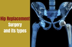 Hip Replacement Surgery and its types - Bone and Joint Care Clinic